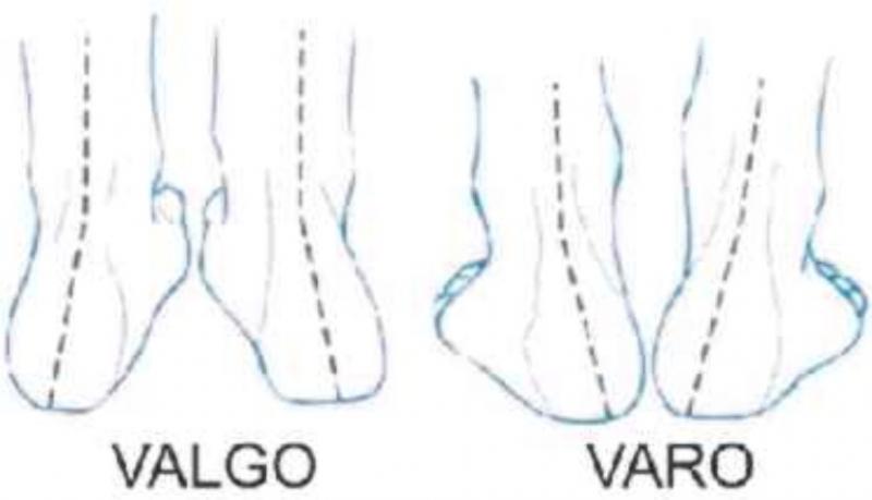 Calcâneo valgo e varo: o que é isso? Experiência e tratamento!