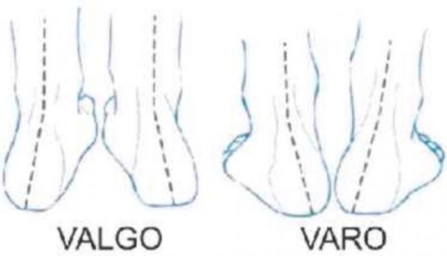 Calcâneo valgo e varo: o que é isso? Experiência e tratamento!