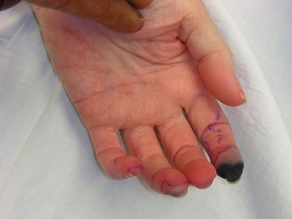 Dedo necrosado tem cura? E reimplante? - Saúde Melhor